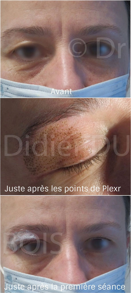 PlexR: pour tout savoir